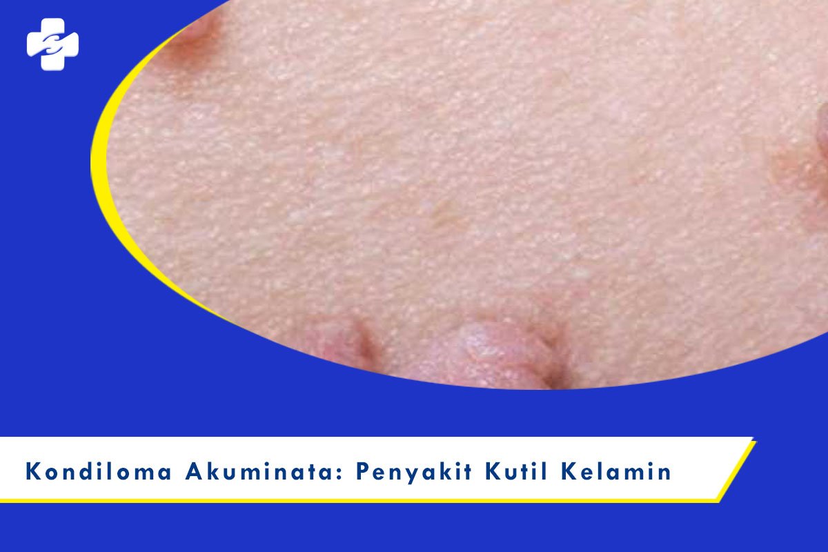 Kondiloma Akuminata: Penyakit Kutil Kelamin dari Virus HPV