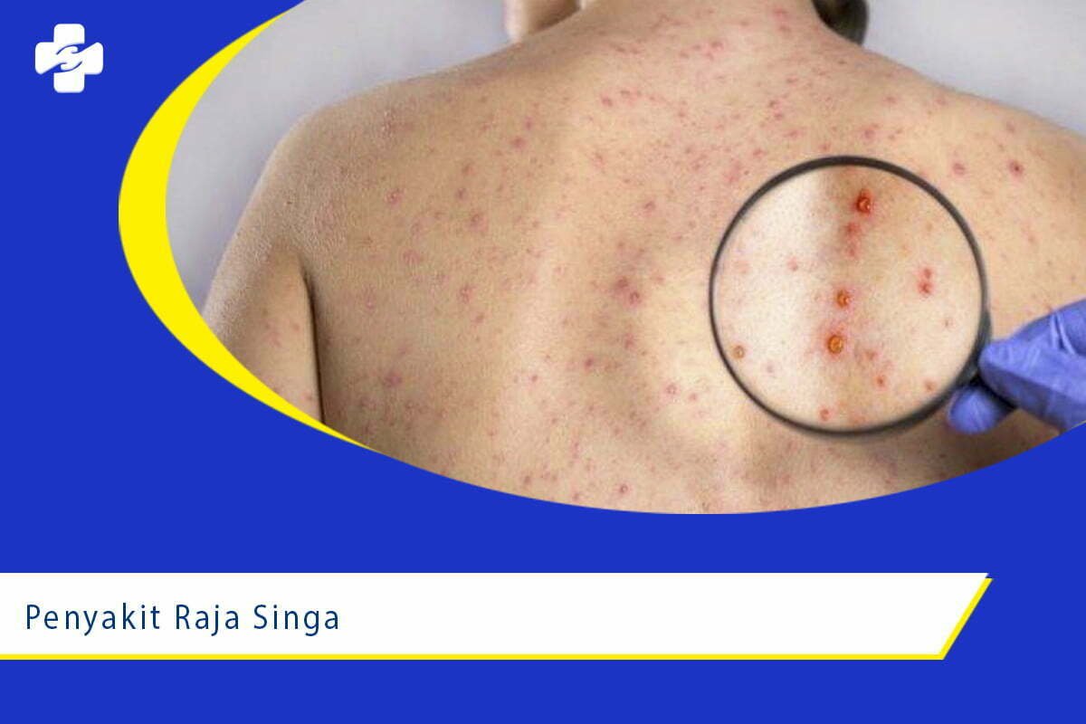 Kenali Jenis Tahapan Penyakit Raja Singa | Klinik Utama Sentosa