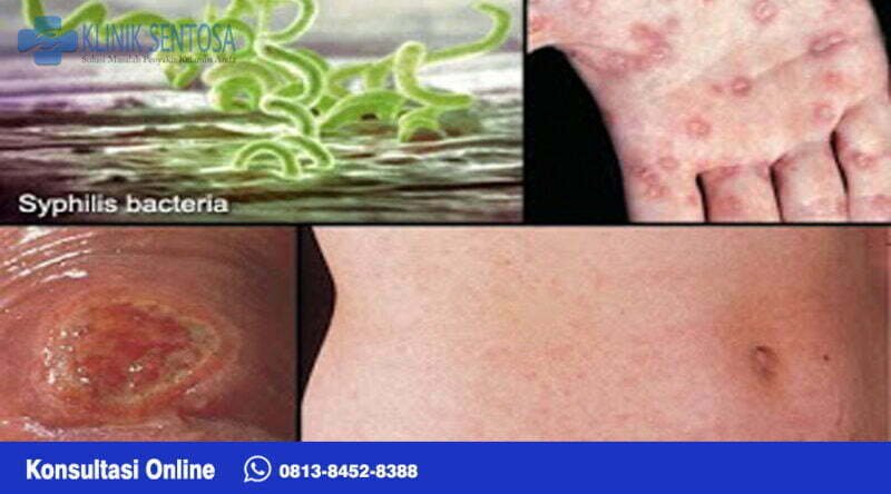 Kenali Jenis Tahapan Penyakit Raja Singa | Klinik Utama Sentosa