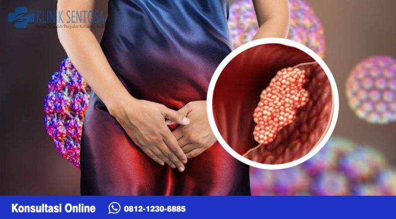 Kenali Orang yang Berisiko Kena Penyakit Jengger Ayam | Klinik Utama ...