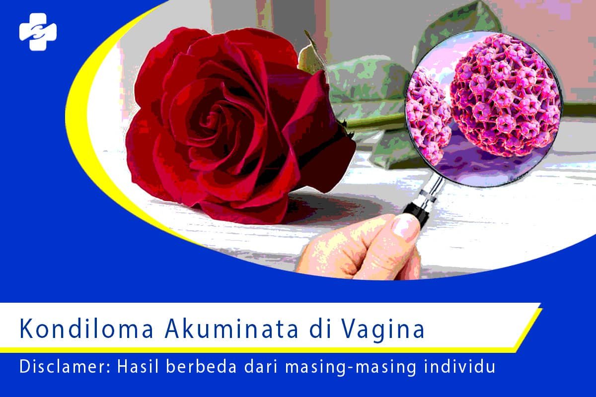 Harus Tahu! Kondiloma Akuminata di Vagina Berbahaya | Klinik Utama Apollo