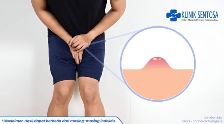 Ada Bisul di Kemaluan Pria, Tanda Bahaya atau Masalah Umum? | Klinik ...