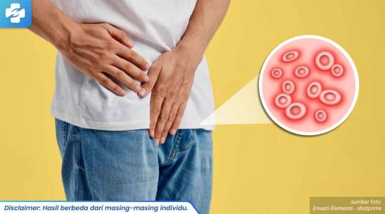 Terapi Medis Kondiloma Akuminata, Pilihan Terbaik! | Klinik Utama Apollo